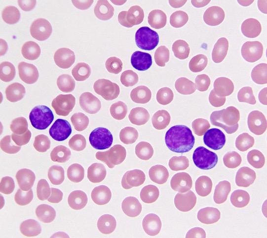 CLL [IMAGE] | EurekAlert! Science News Releases