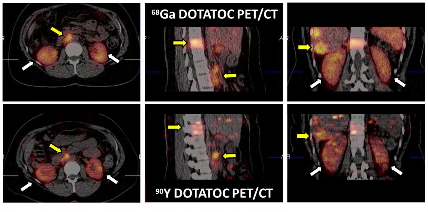 Comparison of Ga-68-DOTATOC PE [IMAGE] | EurekAlert! Science News Releases
