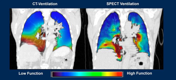 New imaging software improves lung diagnosis | EurekAlert!