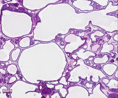 Aggressive Breast Tumor, Post- [IMAGE] | EurekAlert! Science News Releases