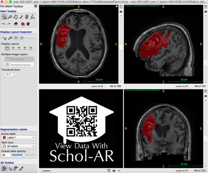 lesion segmentation [IMAGE] | EurekAlert! Science News Releases
