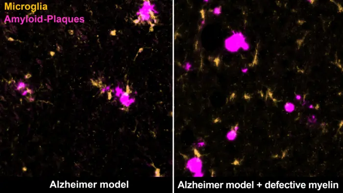 Microglia and amyloid plaques [IMAGE] | EurekAlert! Science News Releases
