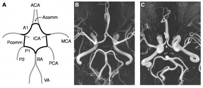 Incomplete Circle of Willis Mo [IMAGE] | EurekAlert! Science News Releases