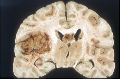 Glioblastoma Multiforme [IMAGE] | EurekAlert! Science News Releases