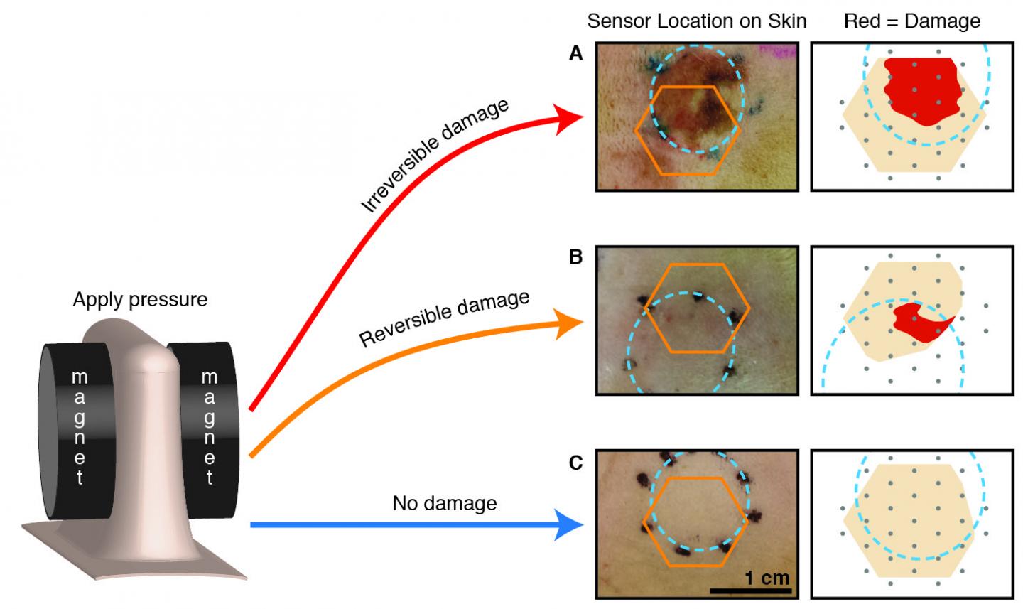 Pressure Wounds [IMAGE] | EurekAlert! Science News Releases