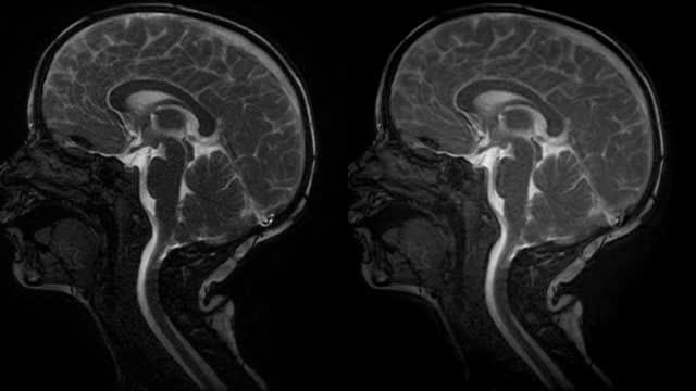 Researchers magnify the brain in motion with | EurekAlert!