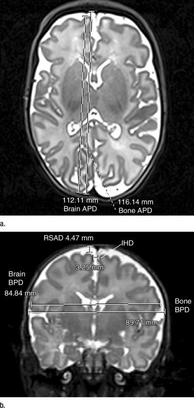 Abnormal Brain Mri
