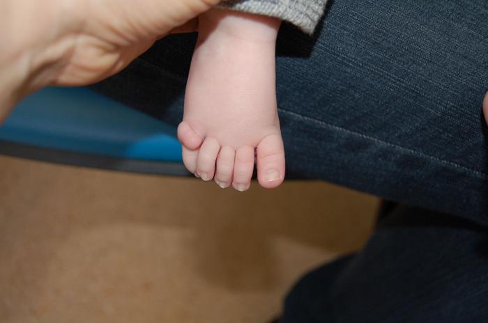 Rare disorder causing extra fingers and toes | EurekAlert!
