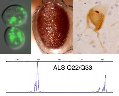 A Genetic Risk Factor for ALS [IMAGE] | EurekAlert! Science News Releases