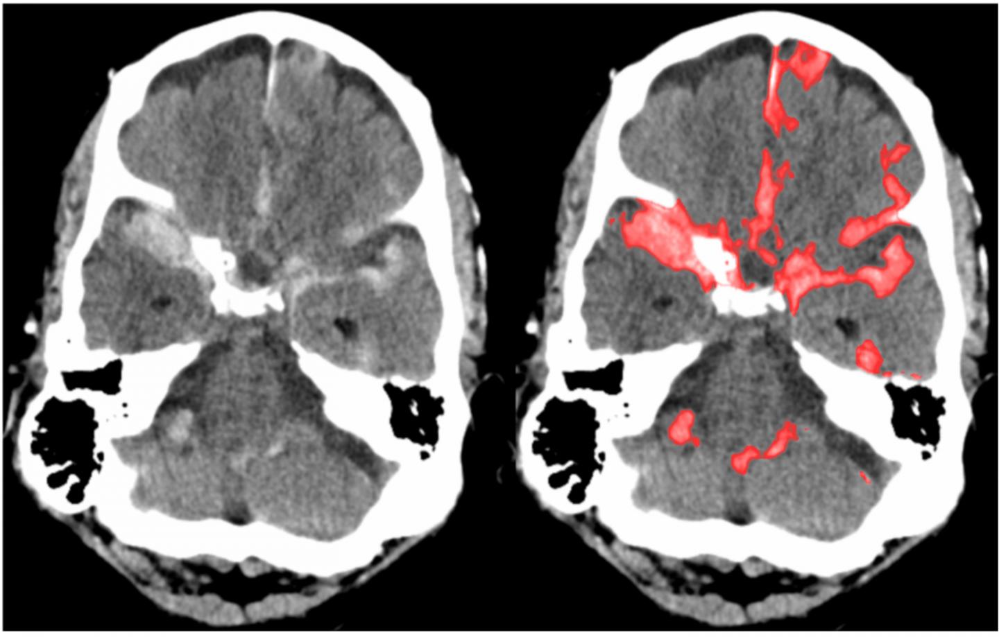 Brain hemorrhage detection by artificial neur | EurekAlert!